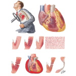 Nonpenetrating Heart Wounds