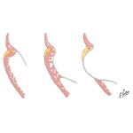 Anomalies of the Tricuspid Valve