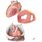 Arteriosclerotic Heart Disease