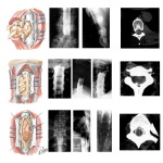 Myelographic and CT Characteristics of Spinal Tumors