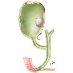 Interrelation of Gallbladder Diseases