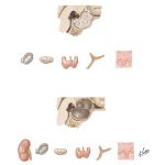 Severe Anterior Pituitary Deficiency or Panhypopituitarism