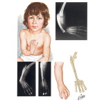 Failure of Formation of Parts: Longitudinal Arrest (Radial Deficiency ...