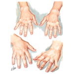 Polyarticular Juvenile Rheumatoid Arthritis