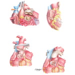 Arterial Repair of Transposition of the Great Arteries Surgical ...