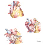 Approaching the Mitral Valve Through the Interatrial Septum