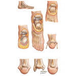 Syme Amputation (Wagner Modification)