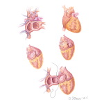 Technique of Orthotopic Biatrial Cardiac Transplantation