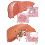Vascular Disturbances III - Periarteritis Nodosa, Aneurysm