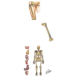 Pathologic Fracture