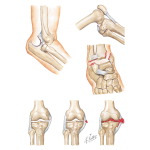 Types of Joint Injury