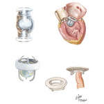 First Generation of Synthetic Prosthetic Valves