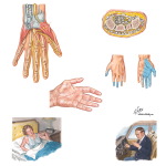 mononeuropathy - meddic