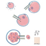 New Techniques in Fertilization