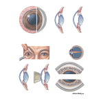 Primary Closed Angle Glaucoma