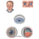 Developmental Glaucoma