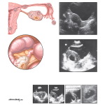 Diagnosis of Ectopic Pregnancy