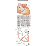 Right Atrial Enlargement