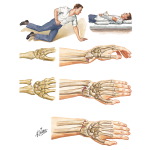 Extension/Compression Fracture of Distal Radius (Colles Fracture)