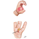 Infection of Deep Compartments of Hand