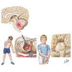 Brain Tumors In Children