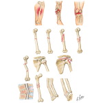 Fractures