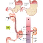 Pyloric Obstruction and the Effects of Vomiting
