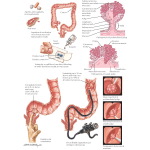 Neoplasms of the Large Bowel: Screening and Treatment of Colon Polyps