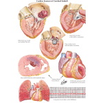 Cardiac Sources of Cerebral Emboli