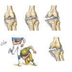 Grading of Ligament Sprains