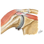 Rotator Cuff Disease