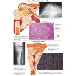Malignant Fibrous Histiocytoma of Bone, Fibrosarcoma of Bone