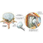 Discectomy