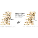 Radiographic Signs of Cervical Spine Instability