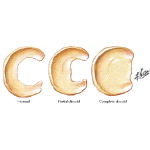 Discoid Meniscus Variations