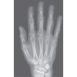 Wrist and Hand: Anteroposterior Radiograph