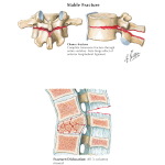 Stable Fracture Vertebral Dislocation and Fractures
