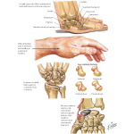 Fracture of the Scaphoid