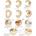 Tears of the Meniscus