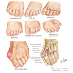 Toe Deformities