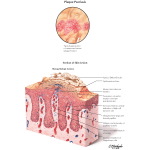 Plaque Psoriasis