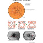 Focal Photocoagulation for Medical Edema