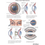 Primary Closed Angle Glaucoma