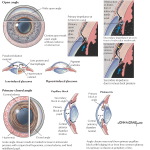 Glaucoma