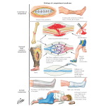 Etiology of Compartment Syndrome