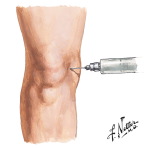 Aspiration of Joint Fluid In the Knee
