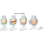 Fracture of Patella