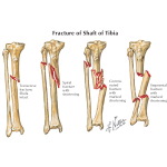 Fracture of Shaft of Tibia