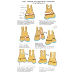 Injury to Growth Plate (Salter-Harris Classification, Rang Modification)
