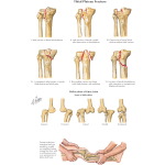 Trauma of the Leg and Knee Tibial Plateau Fracture
